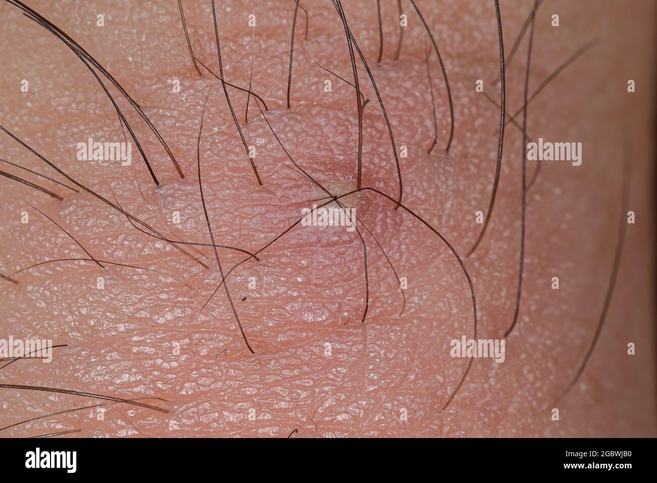 Ingrown hair hi-res stock photography and images - Alamy