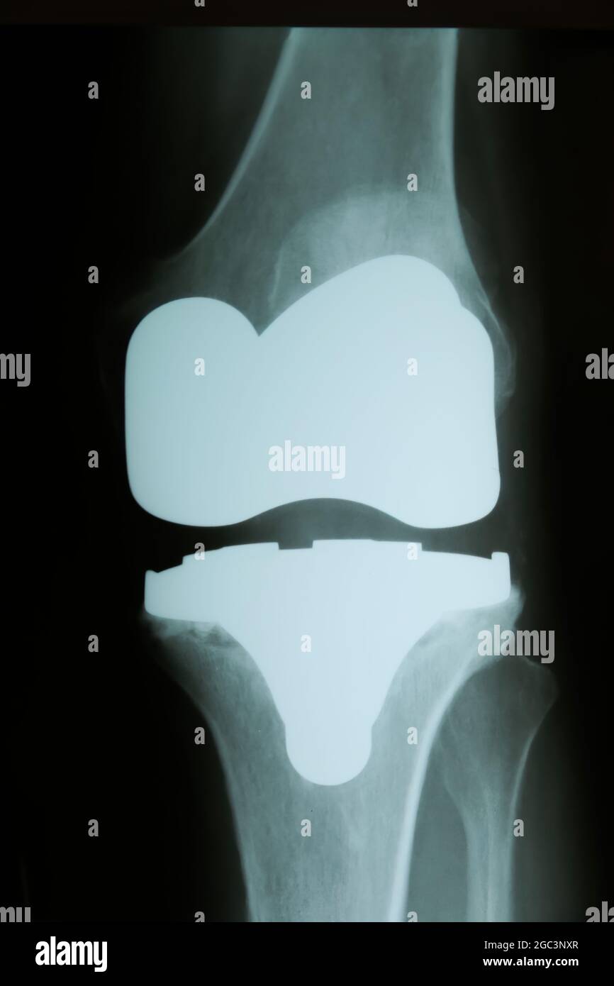 X-Ray image of knee with complete artificial joint replacement ...