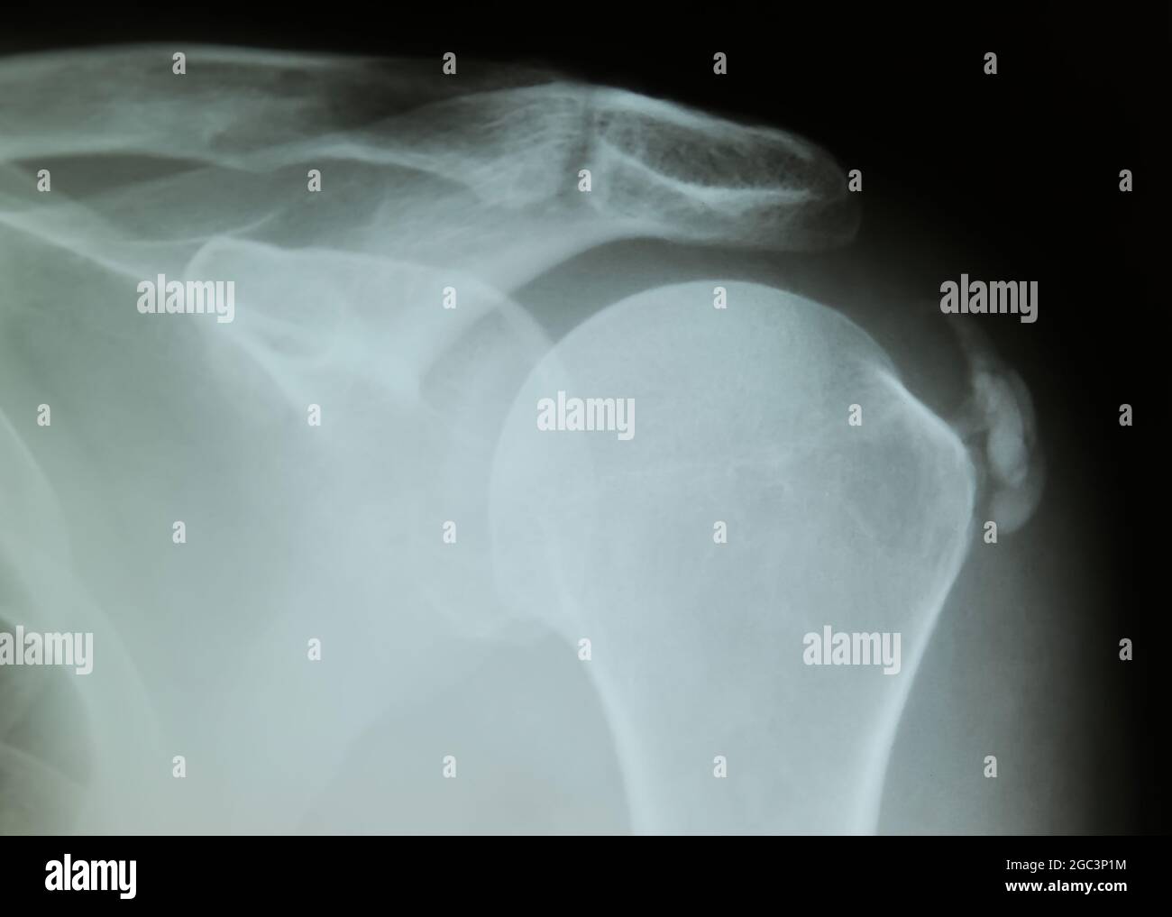 X-Ray image of calcified shoulder (Tendinosis calcarea Stock Photo - Alamy