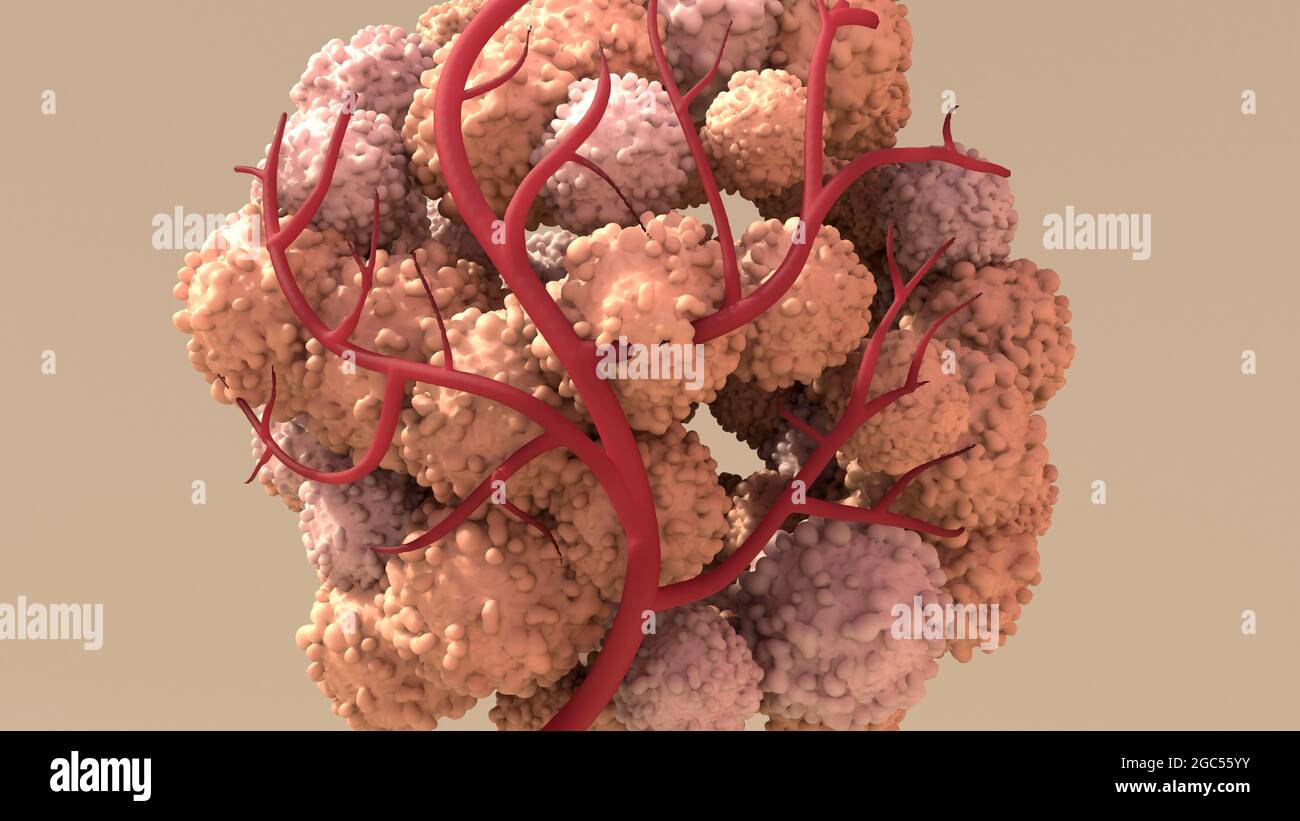 Tumour growth, illustration Stock Photo - Alamy