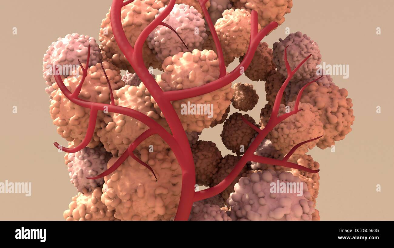 Tumour growth, illustration Stock Photo - Alamy