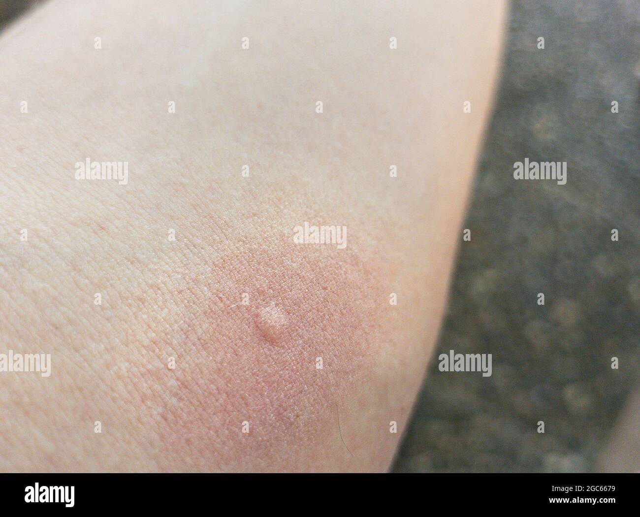 Close-up of skin with a mosquito bite and reddened skin Stock Photo - Alamy