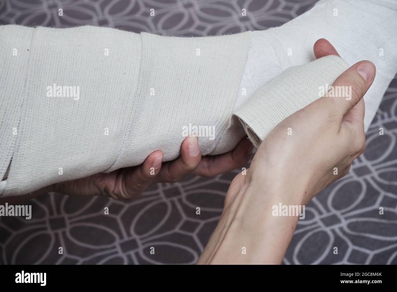 Applying an elastic bandage to a broken leg The leg is in a plaster ...