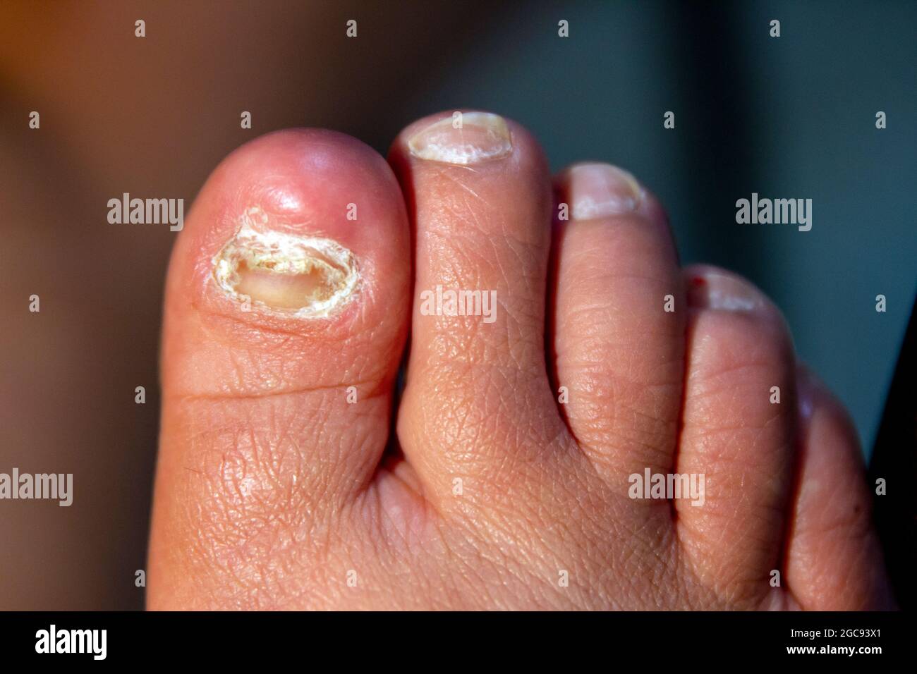 Toenail that has fallen off Stock Photo - Alamy