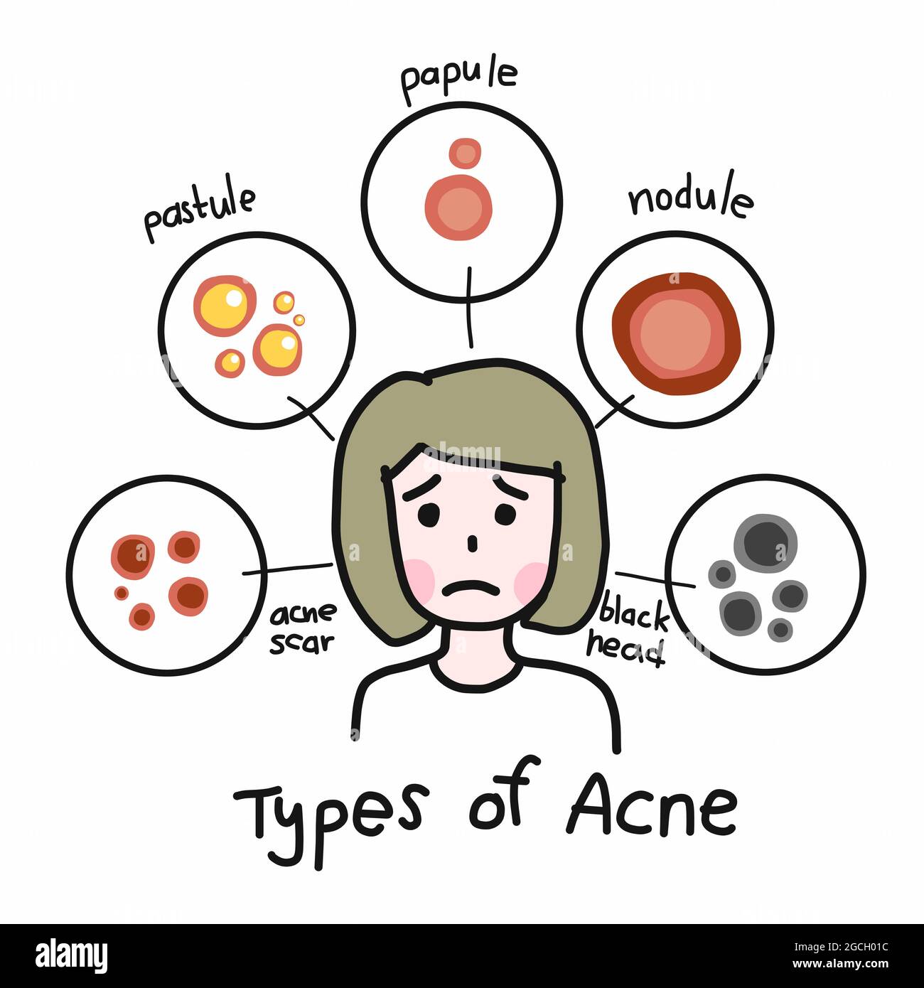 Type of acne , Cute woman cartoon face vector illustration Stock Vector ...
