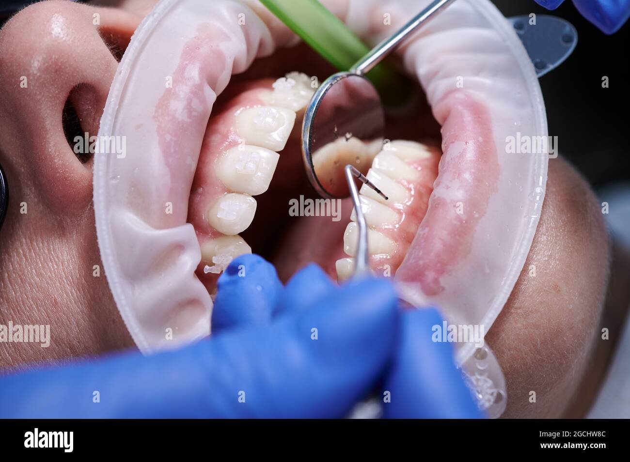 Close up of orthodontist checking woman teeth with dental mirror and ...