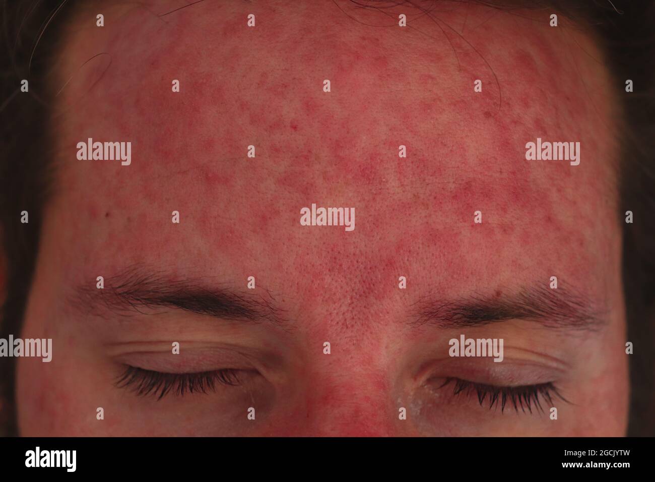 Caucasian male's face becomes red and itchy because of eczema Stock ...