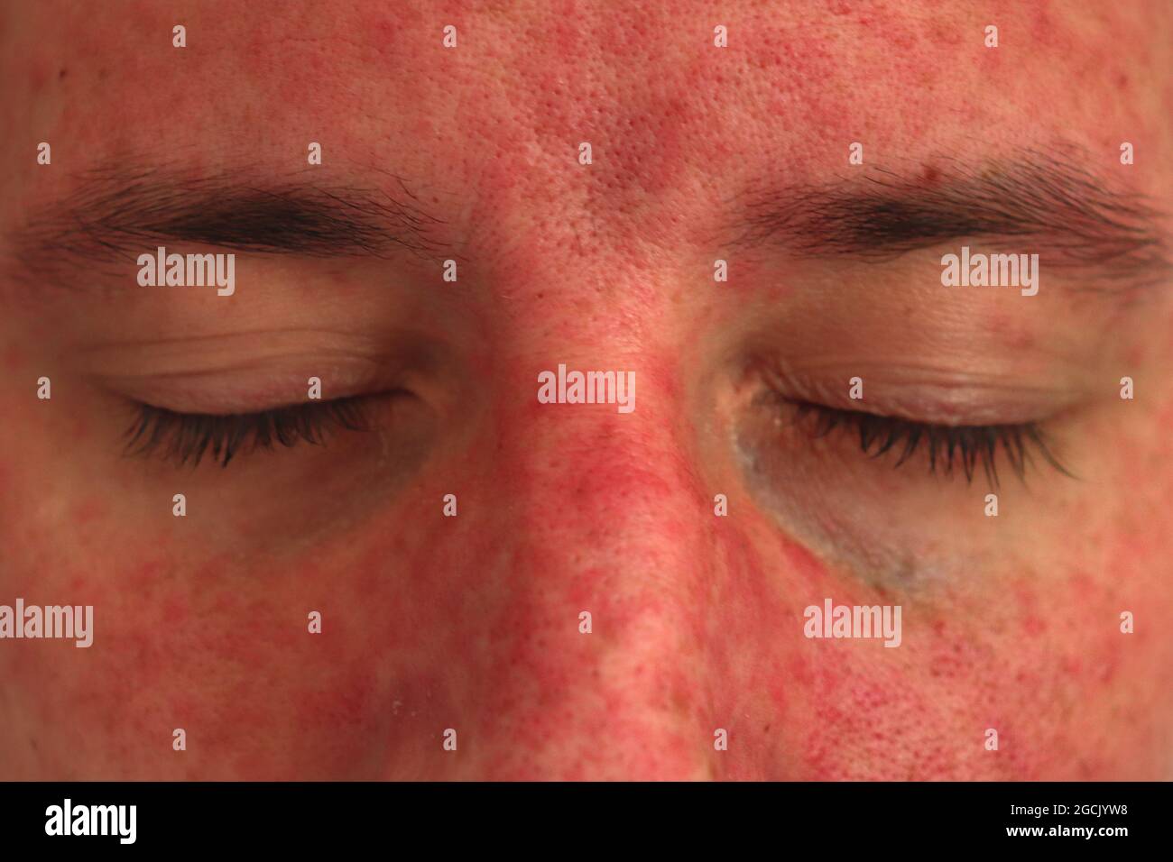 Caucasian male's face becomes red and itchy because of eczema Stock ...