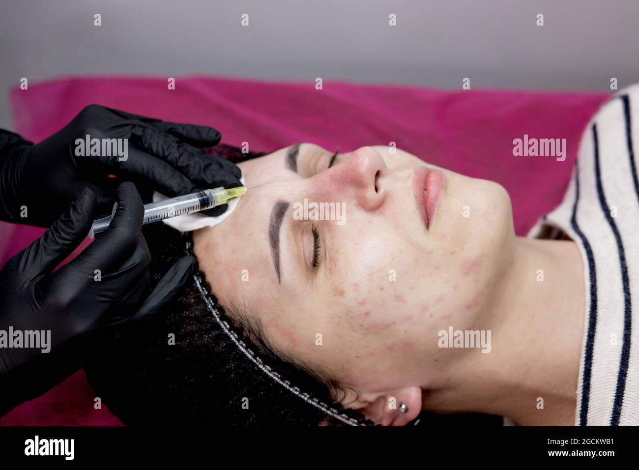 Cosmetologist doctor is making multiple injections biorevitalization ...