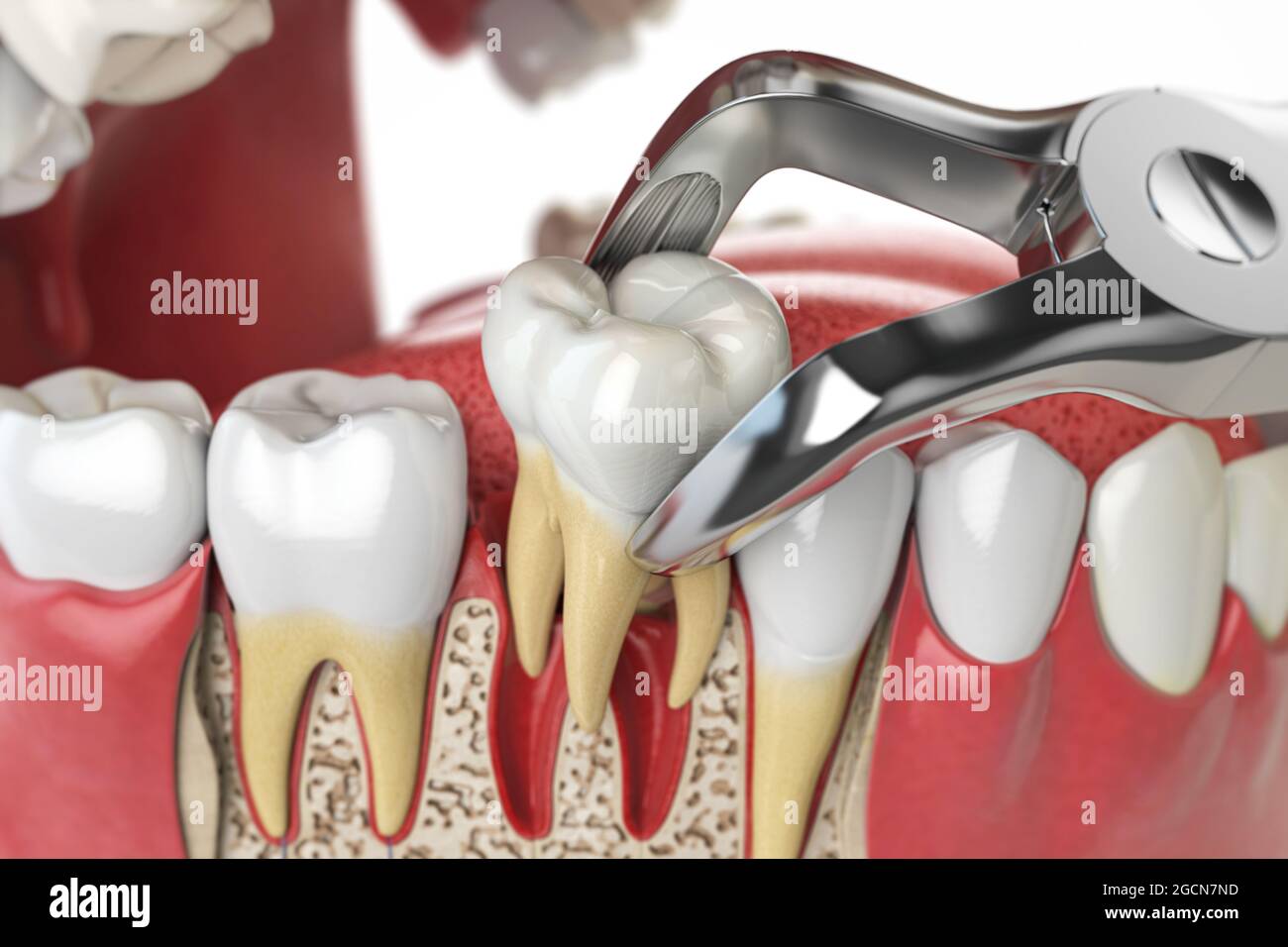 Tooth extraction by dental forceps on model of human jaw. 3d ...
