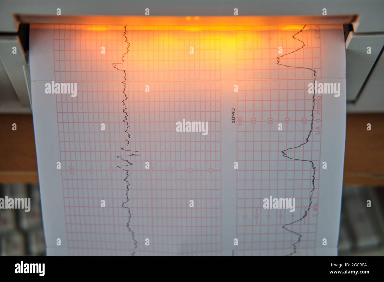 CTG device with monitoring of the state of health of the mother and ...