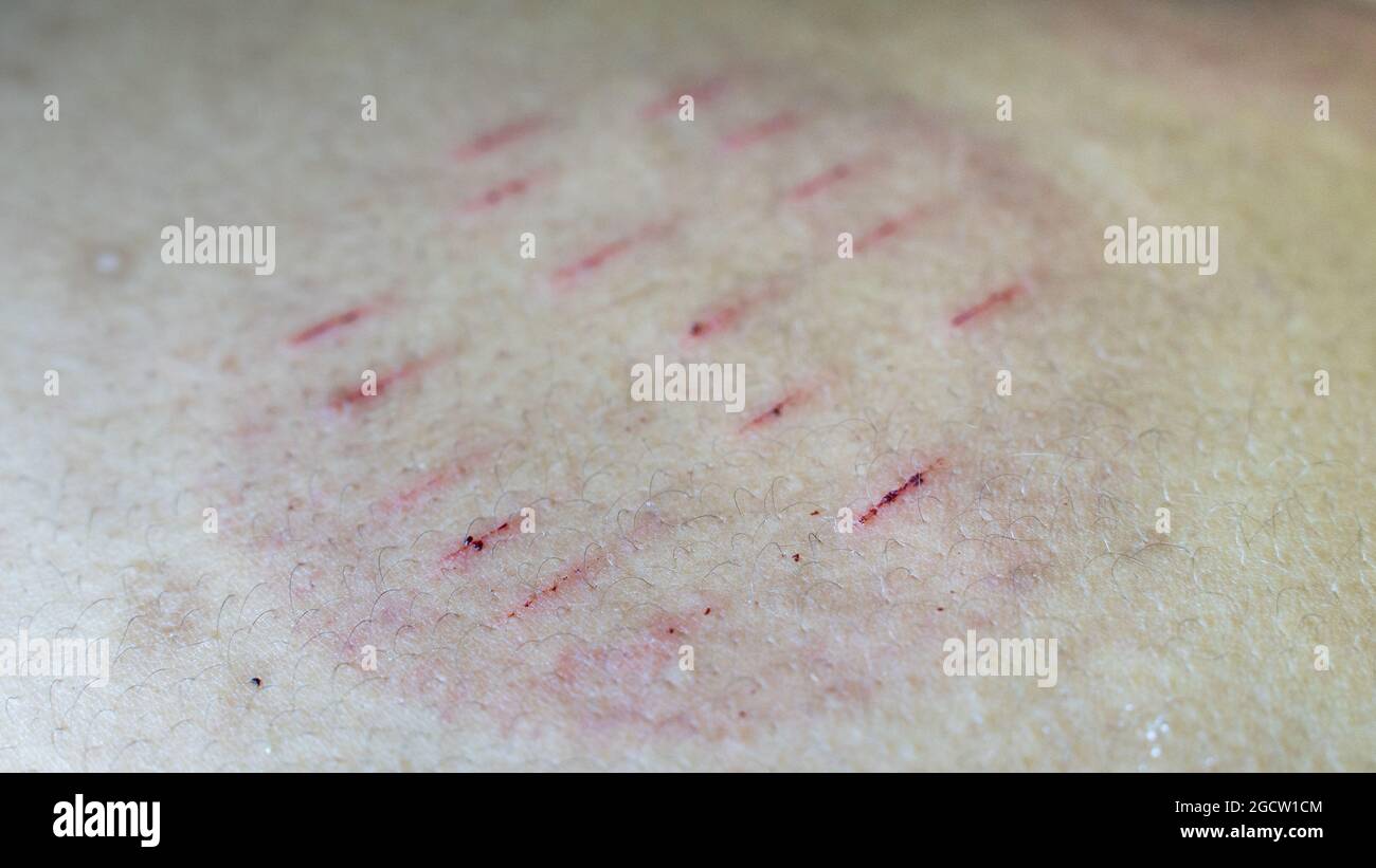 Hijama hi-res stock photography and images - Alamy