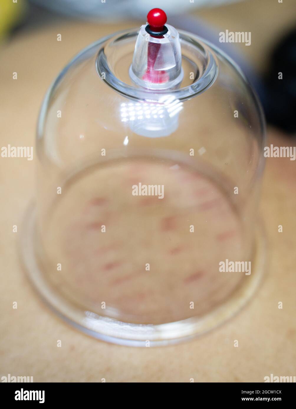 Traces after the hijama procedure on the body. Close up Stock Photo - Alamy