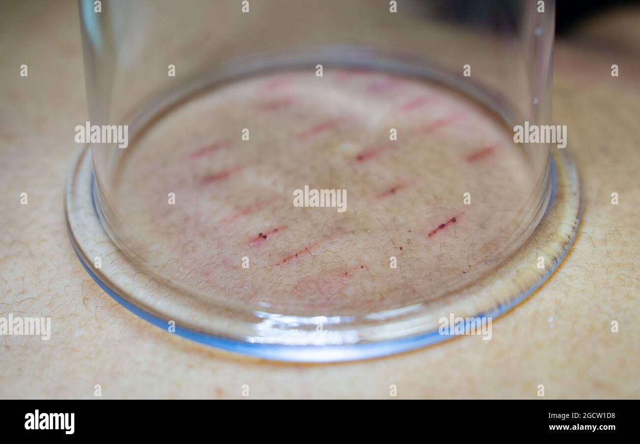 Hijama hi-res stock photography and images - Alamy