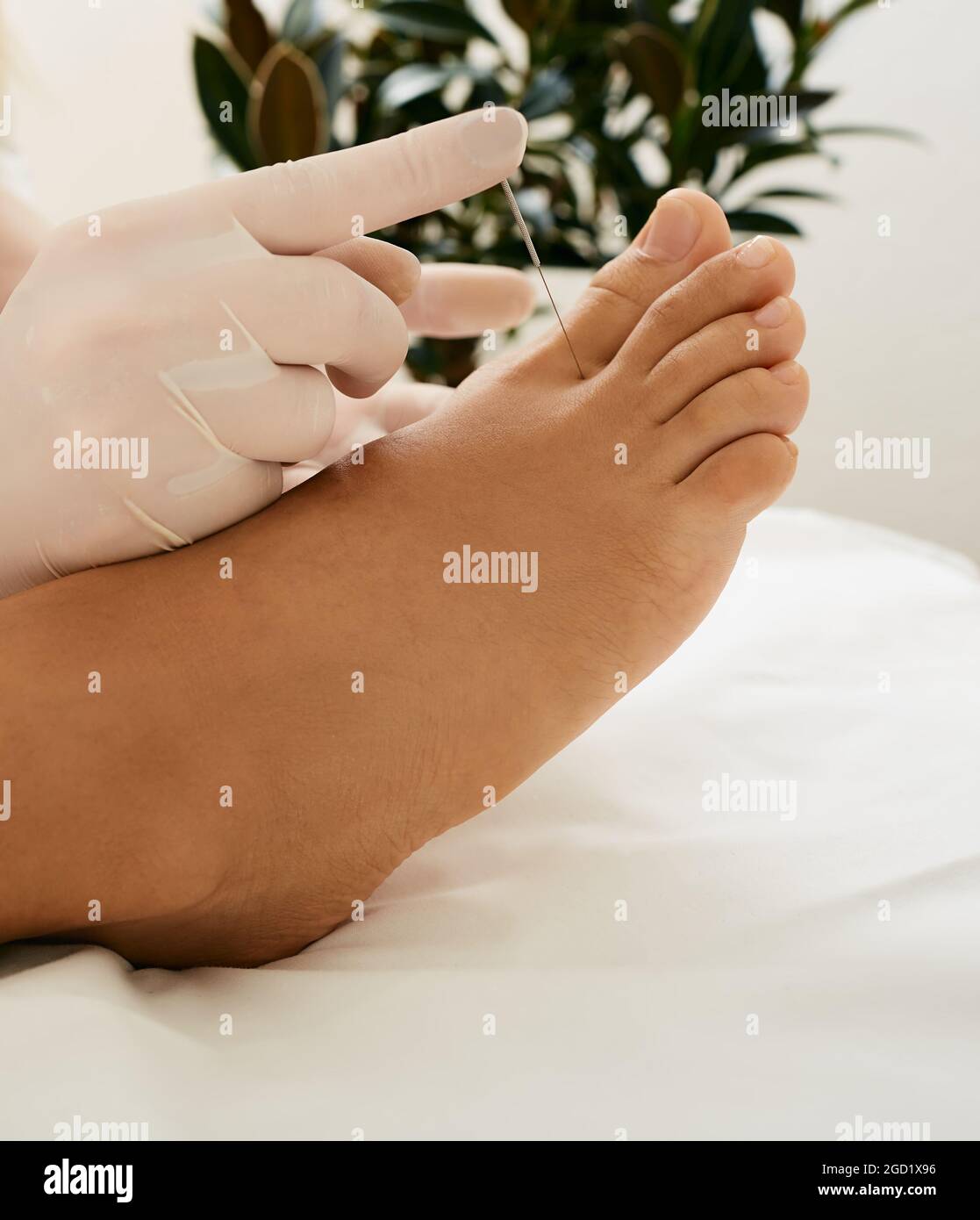 Acupuncturist doing puncture on active foot point on meridian system ...