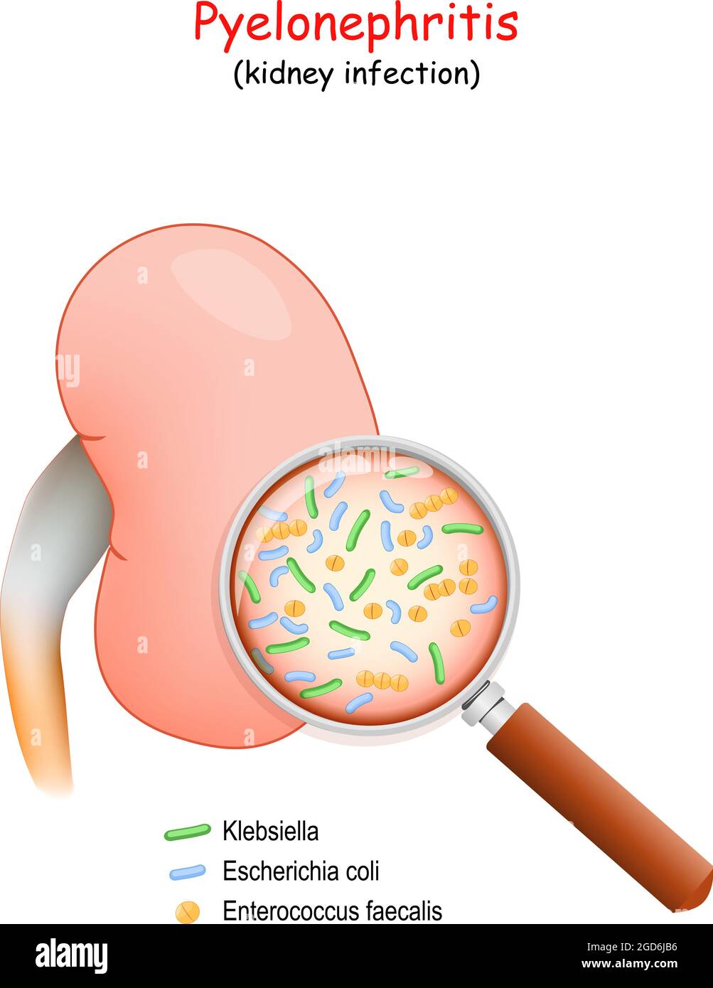 Pyelonephritis. kidney infection. magnifying glass. Close-up of ...
