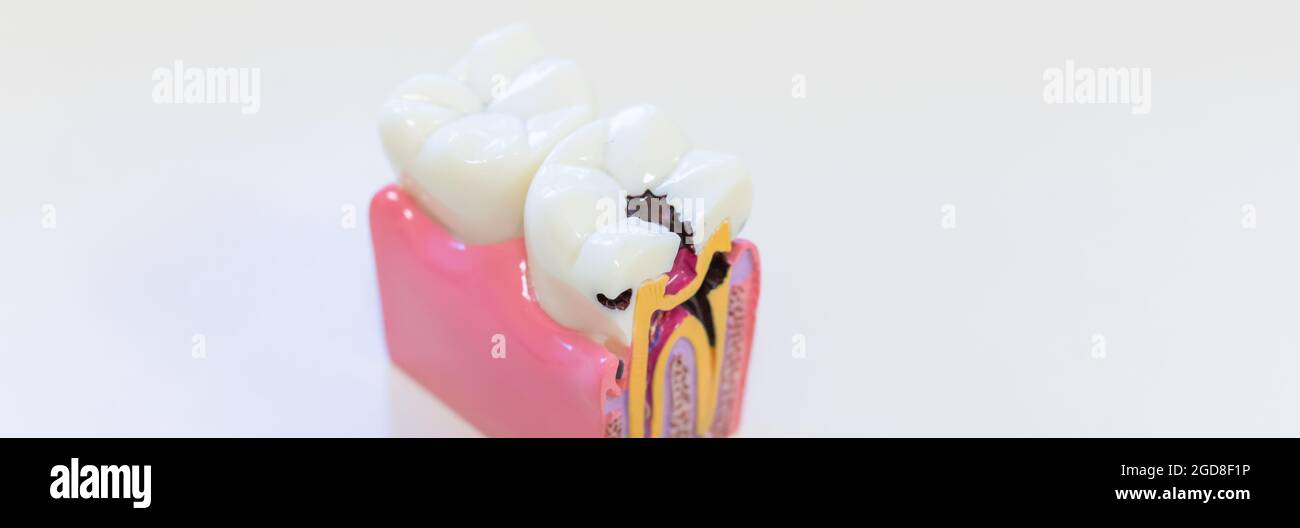 An example of dental disease. Jaw teeth. Dentistry. Mock jaw man ...