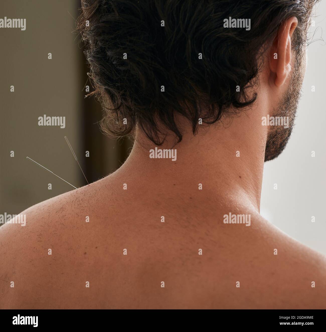 Treatment of back pain and shoulders tightness with acupuncture needles ...