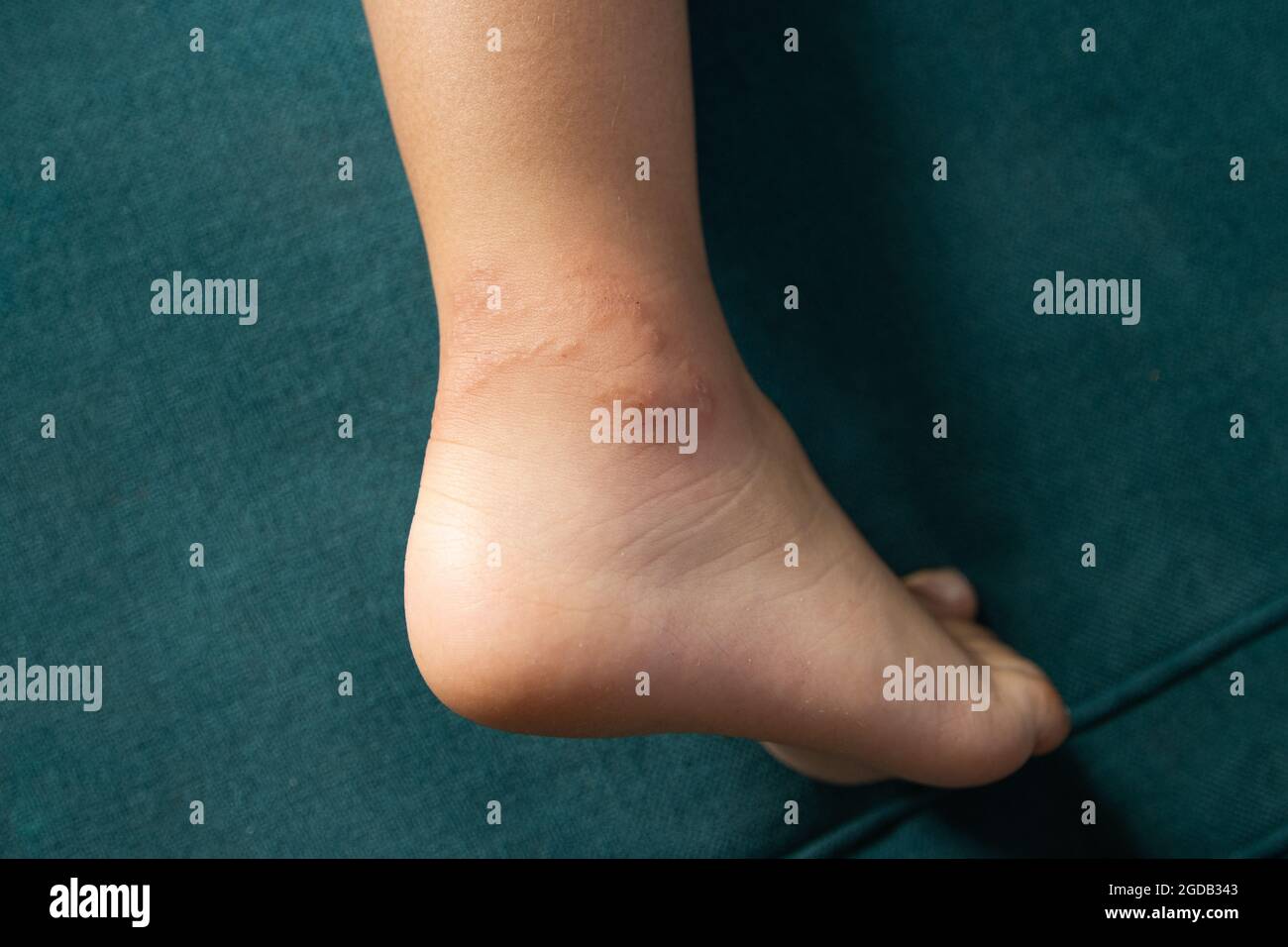 Jellyfish Stingers In Skin