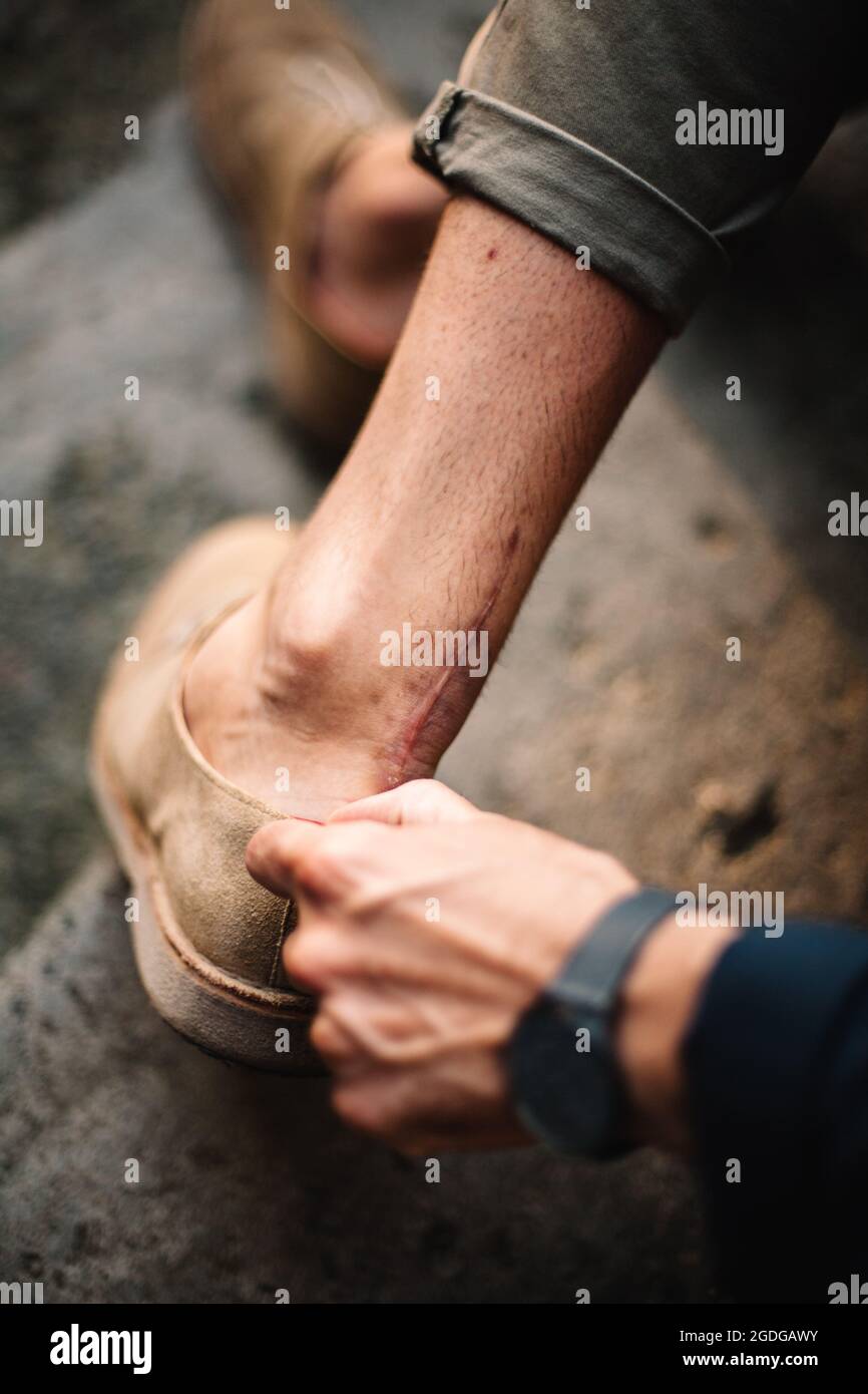Achilles tendon surgery hi-res stock photography and images - Alamy
