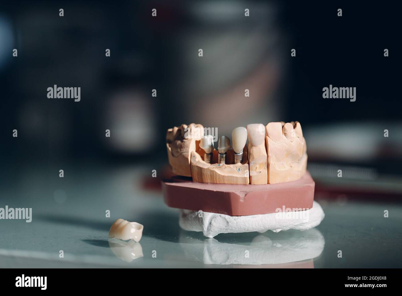 Dental layout of the human jaw with teeth and implants Stock Photo - Alamy