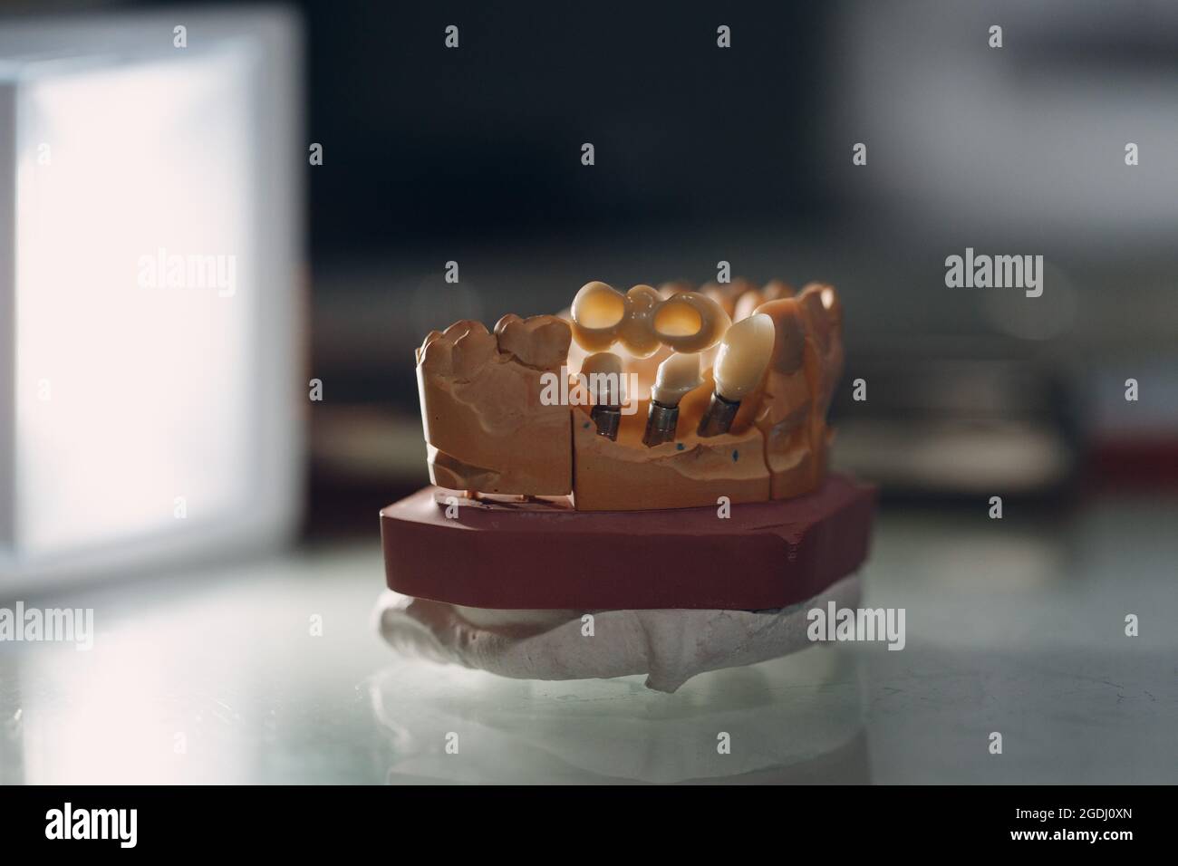 Dental layout of the human jaw with teeth and implants Stock Photo - Alamy