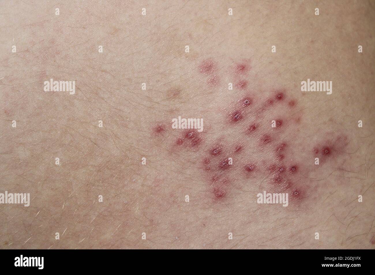 Shingles Rash Spots Drying on Man Skin Stock Photo - Alamy