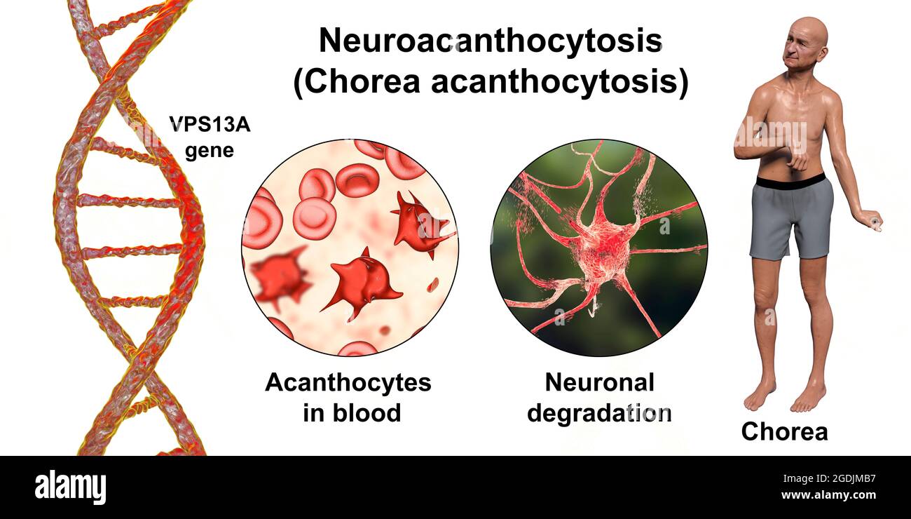 Neuroacanthocytosis, conceptual illustration Stock Photo - Alamy
