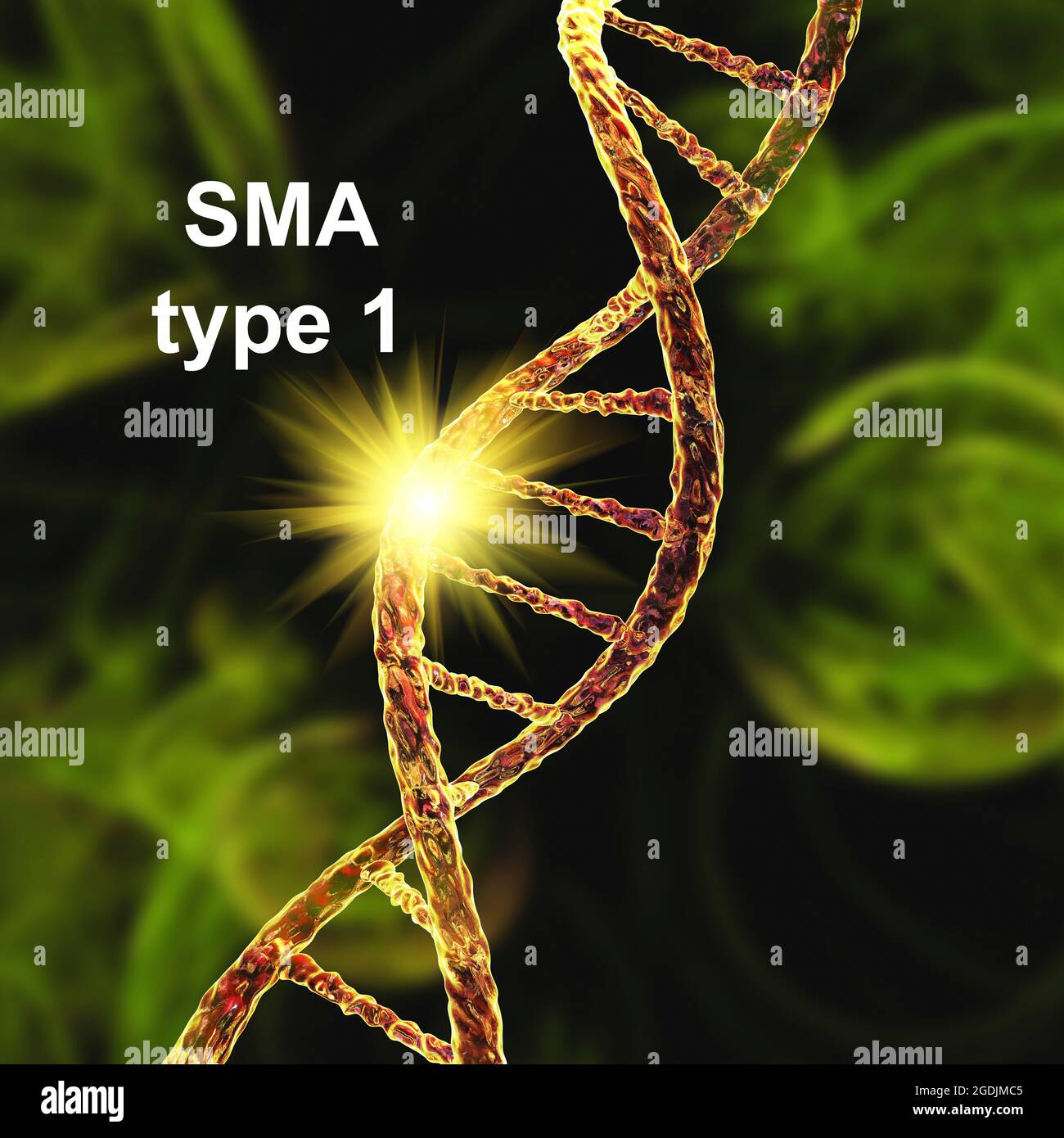 Spinal muscular atrophy, illustration Stock Photo - Alamy