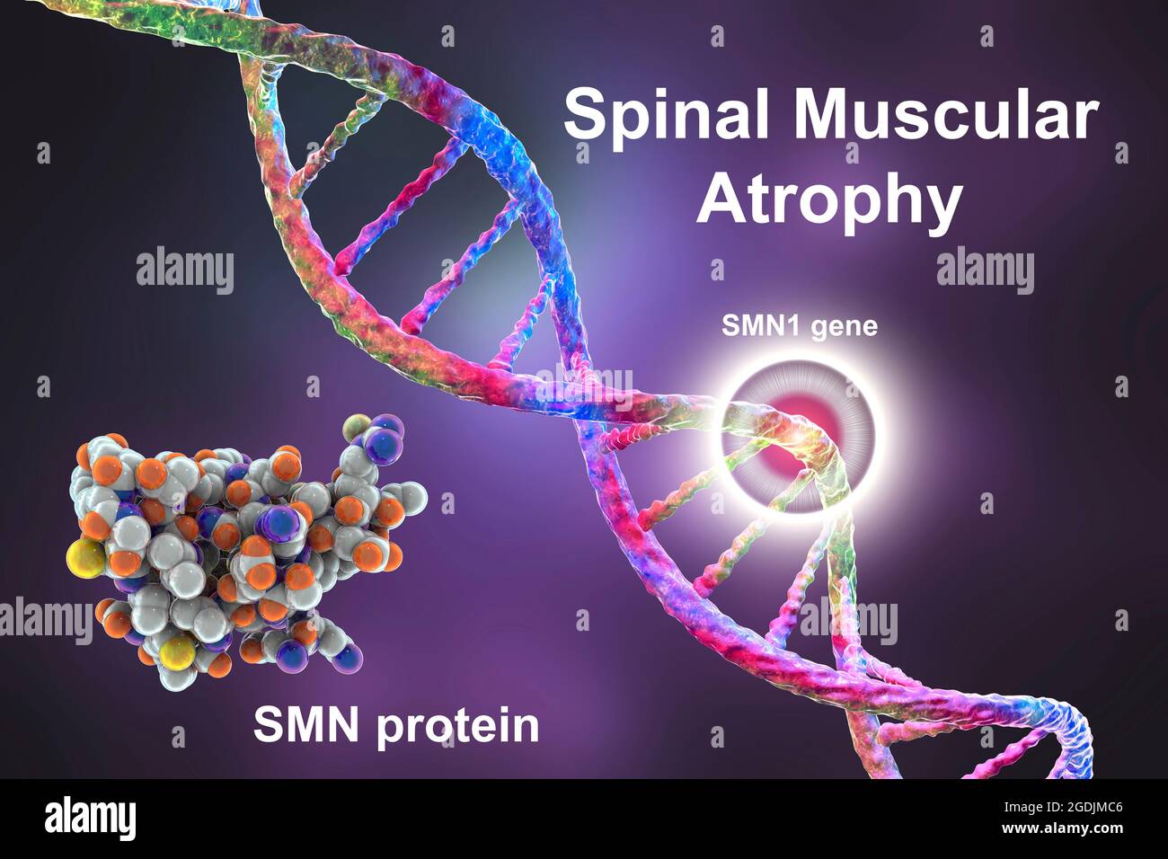 Spinal muscular atrophy, illustration Stock Photo - Alamy