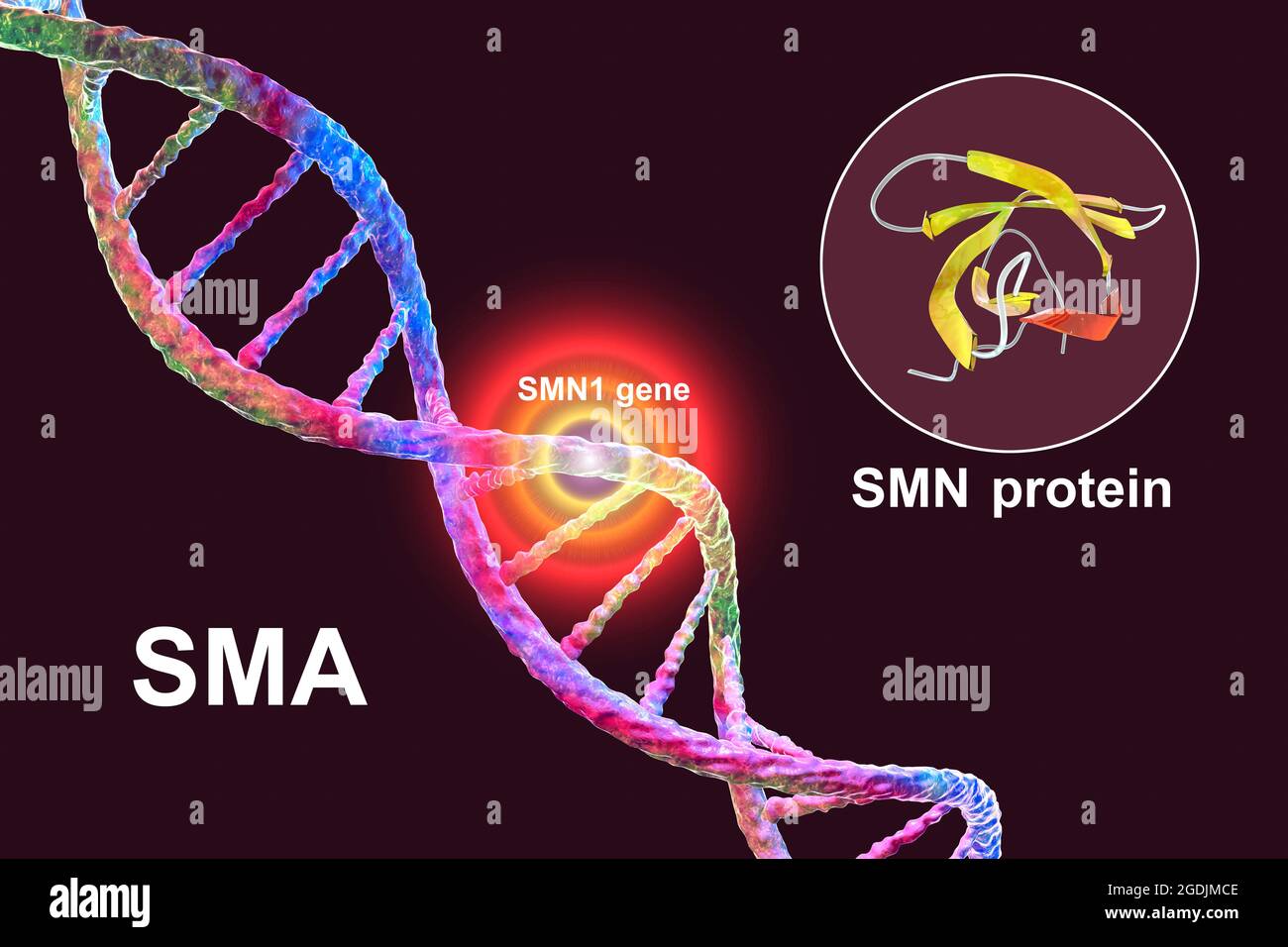Spinal muscular atrophy, illustration Stock Photo - Alamy