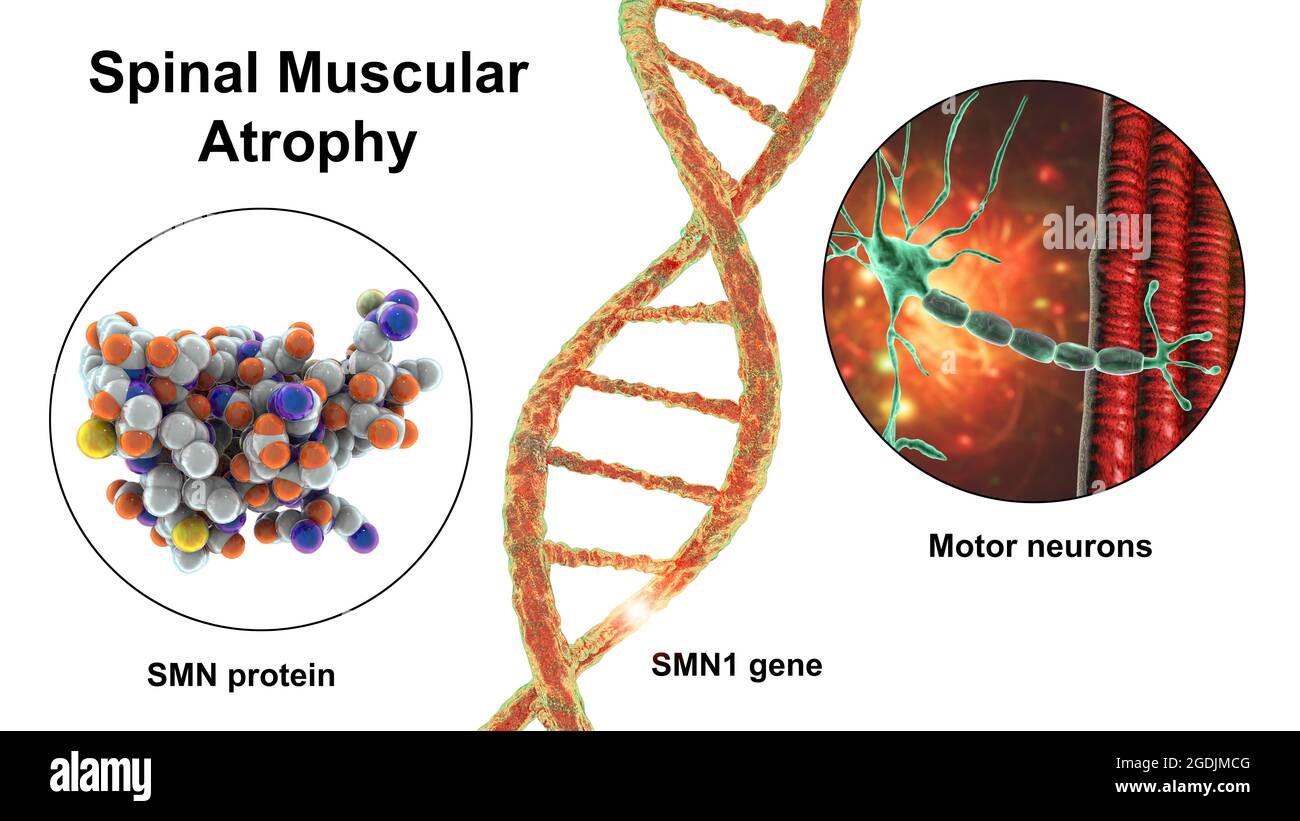Spinal muscular atrophy, illustration Stock Photo - Alamy