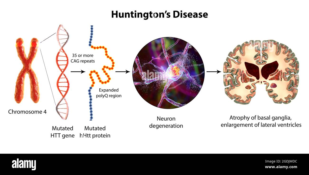 Molecular genesis of Huntington's disease, 3D illustration Stock Photo ...