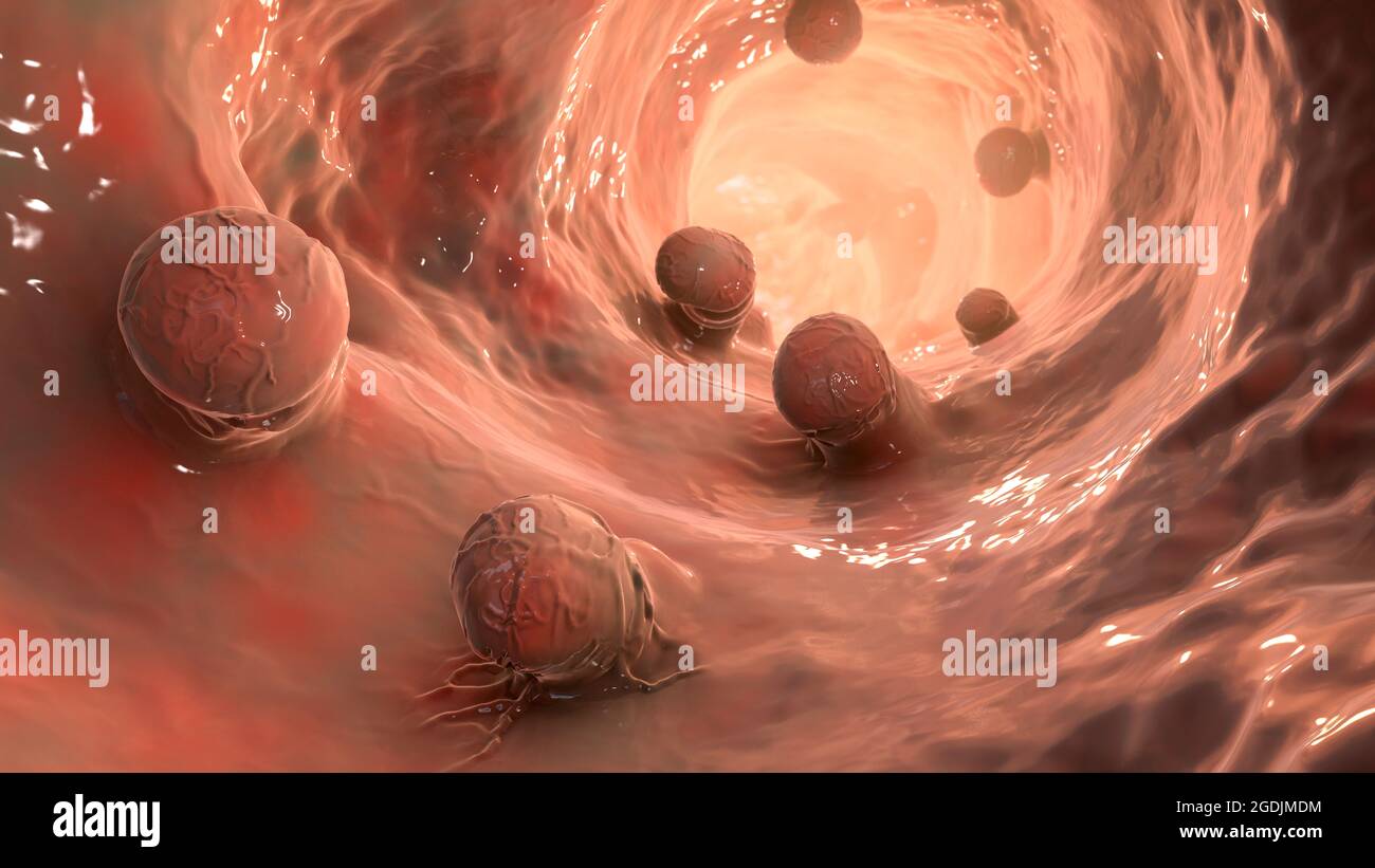 Large intestine endoscopy hi-res stock photography and images - Alamy