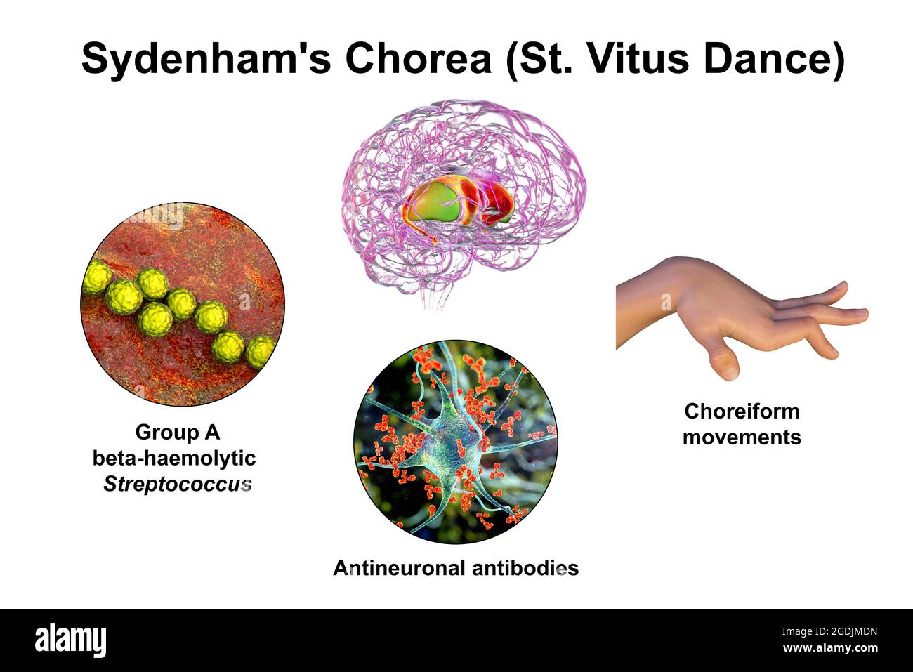 Choreiform movement hi-res stock photography and images - Alamy