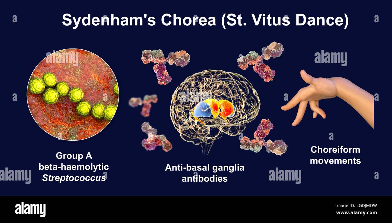 Sydenham's chorea, illustration Stock Photo - Alamy