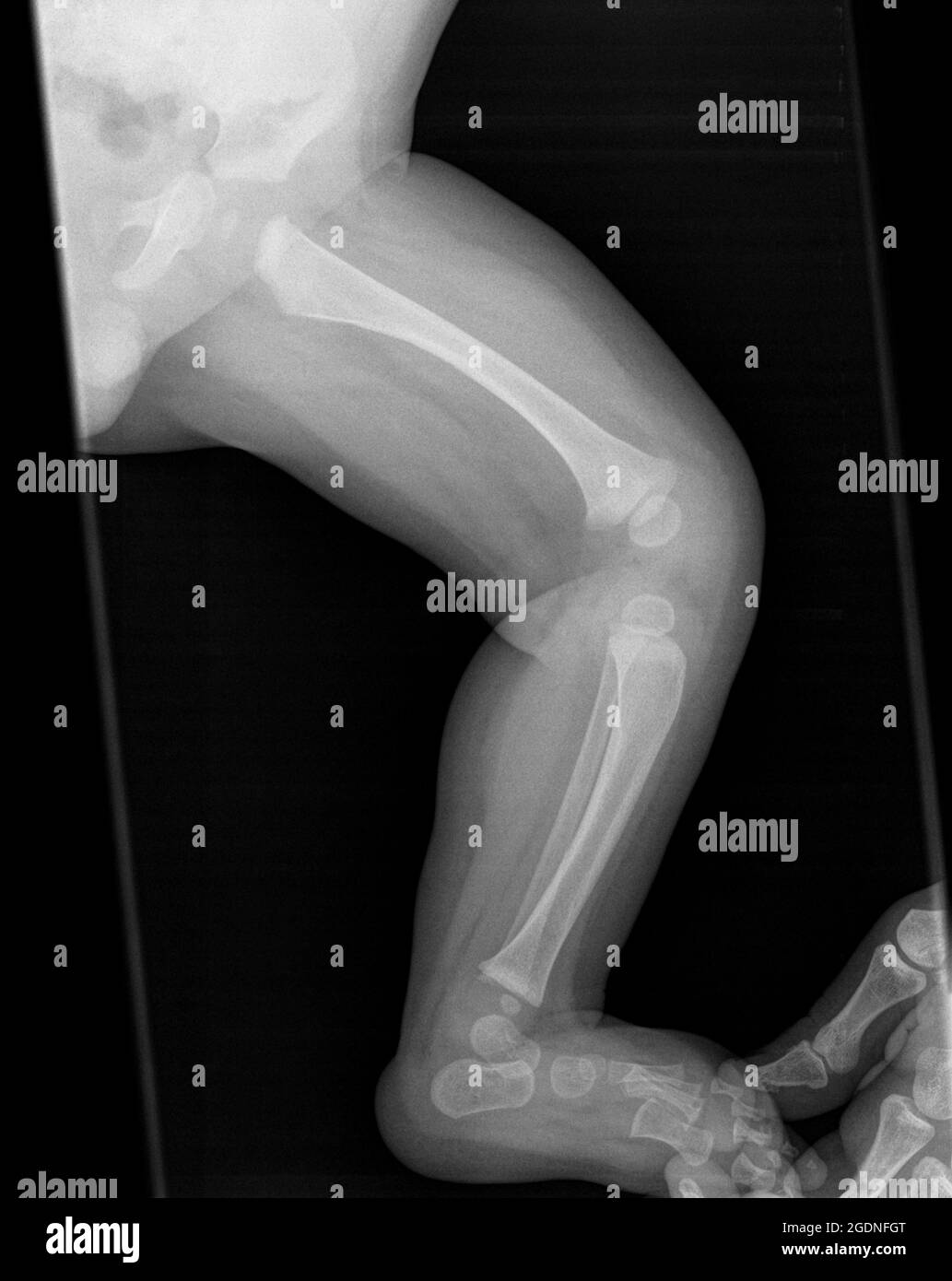 7 month old baby with distal fracture in femur Stock Photo - Alamy