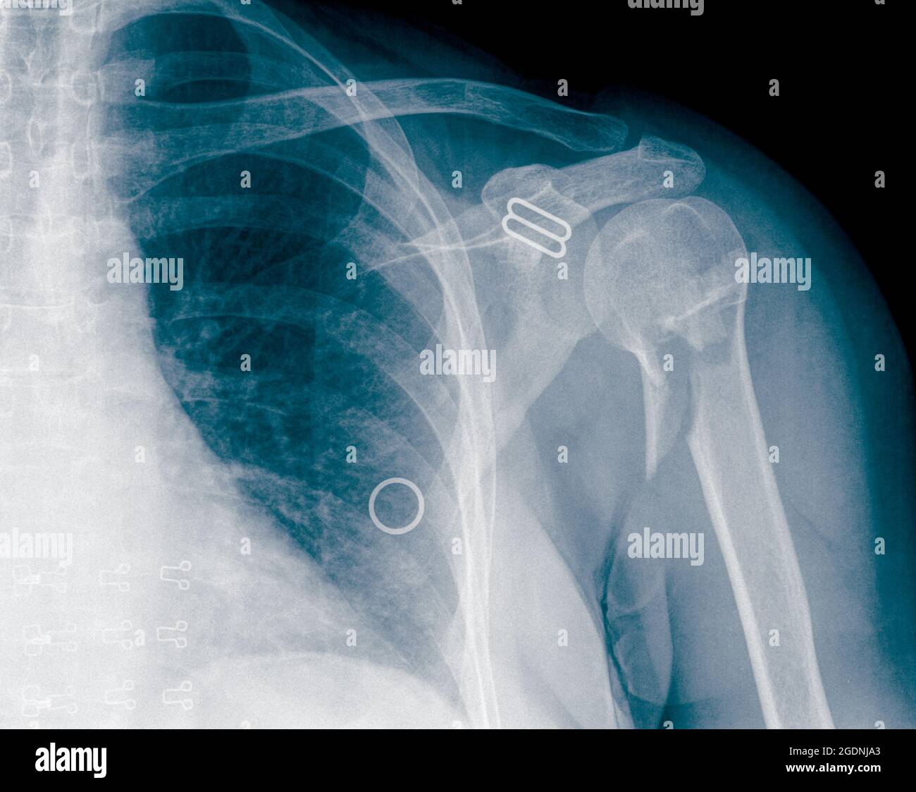 fracture of the Humerus bone after surgery 64 year old female Stock ...