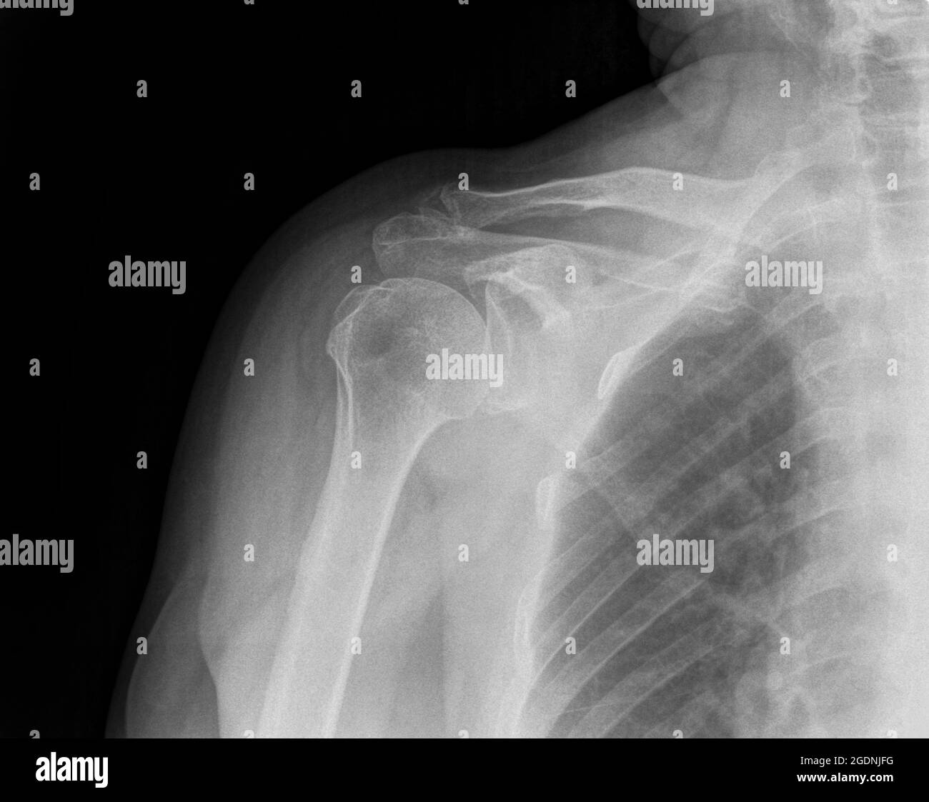 Human shoulder anatomy hi-res stock photography and images - Alamy