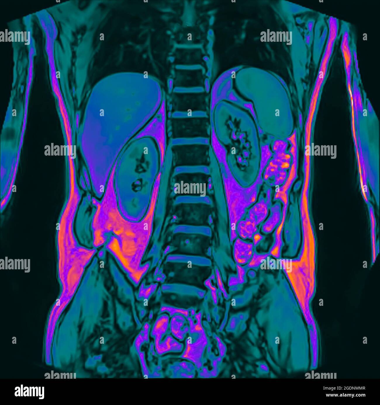 Kidney tumor mri scan hi-res stock photography and images - Alamy