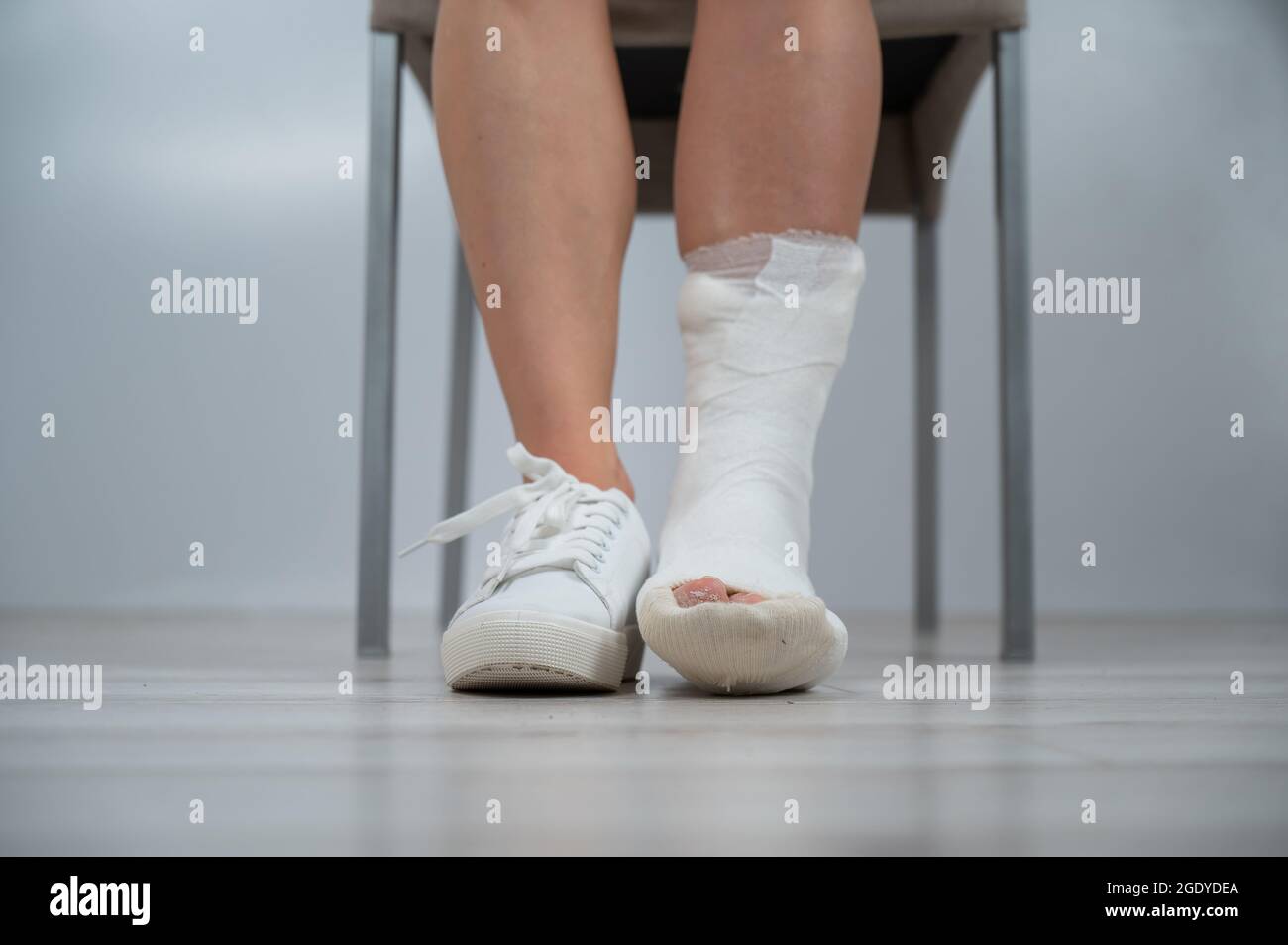 Close-up of female legs with plaster cast. A woman with a broken leg ...
