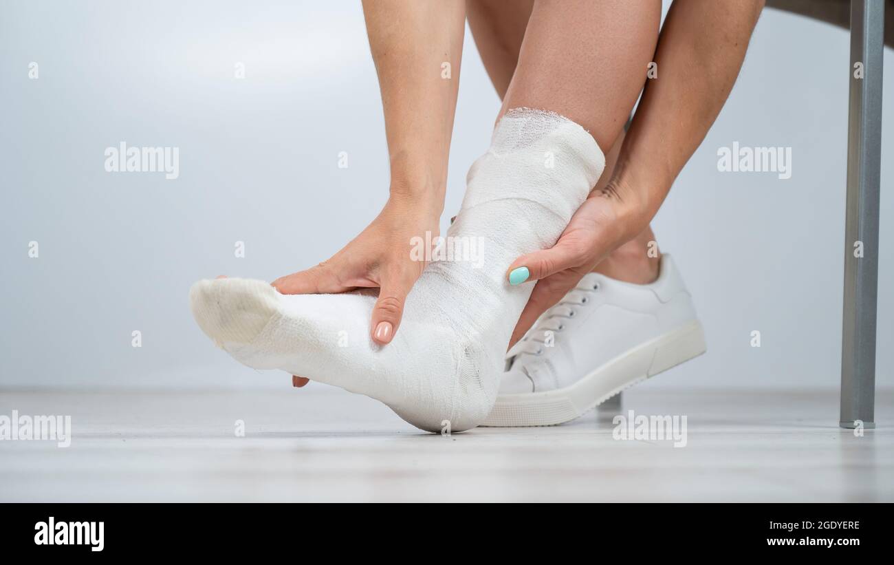 Close-up of female legs with plaster cast. A woman with a broken leg ...