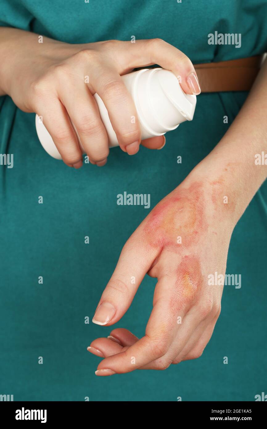 Hand Burn Scar High Resolution Stock Photography and Images - Alamy