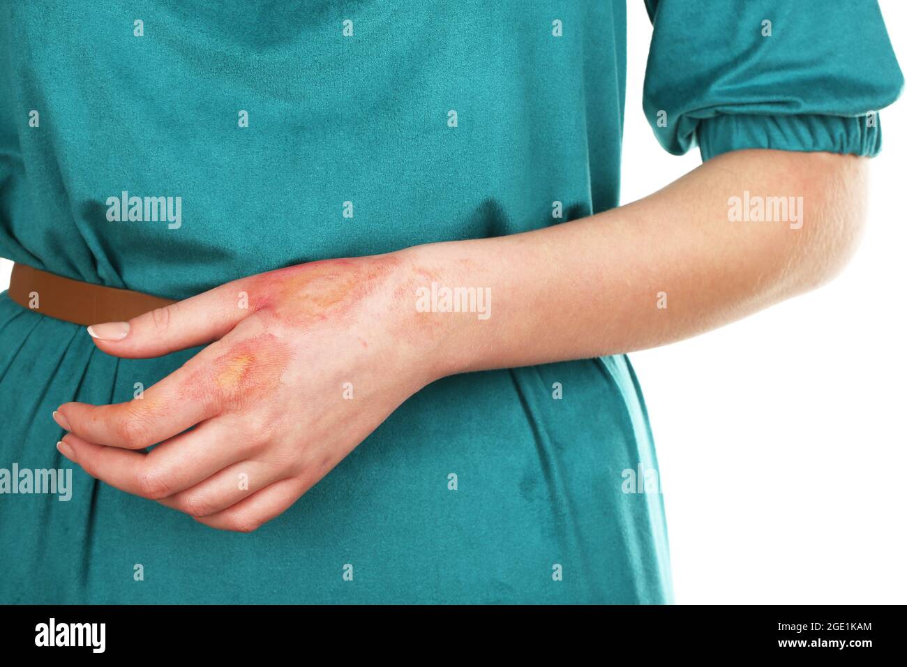 Horrible burns on female hand on white background Stock Photo - Alamy