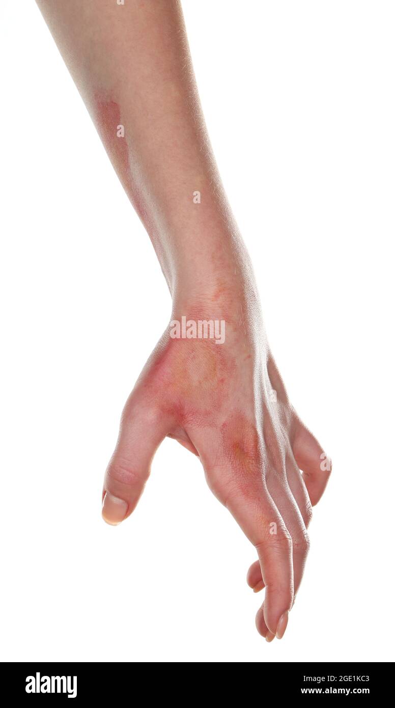 Horrible burns on female hand isolated on white Stock Photo - Alamy