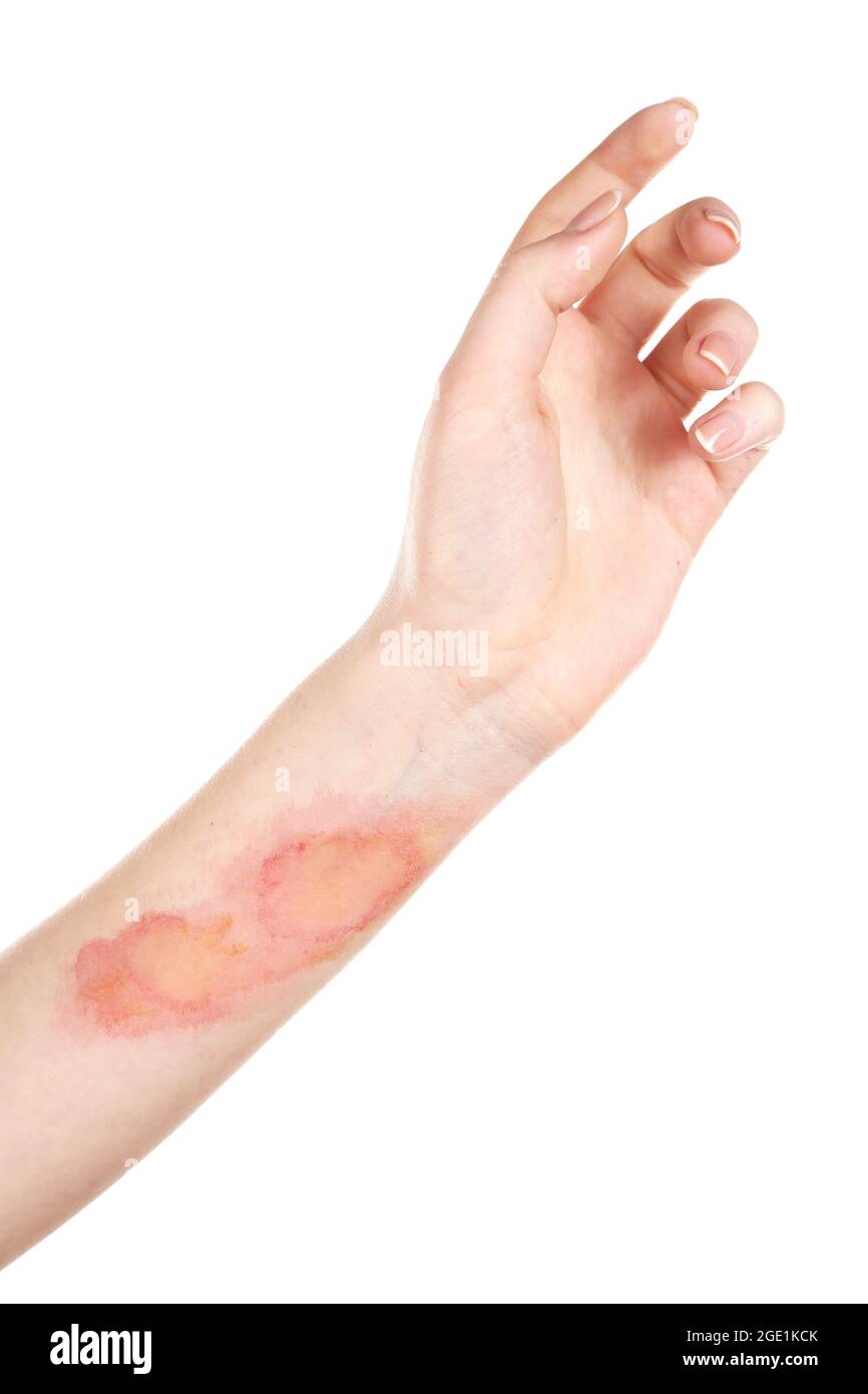 Horrible burns on female hand isolated on white Stock Photo - Alamy