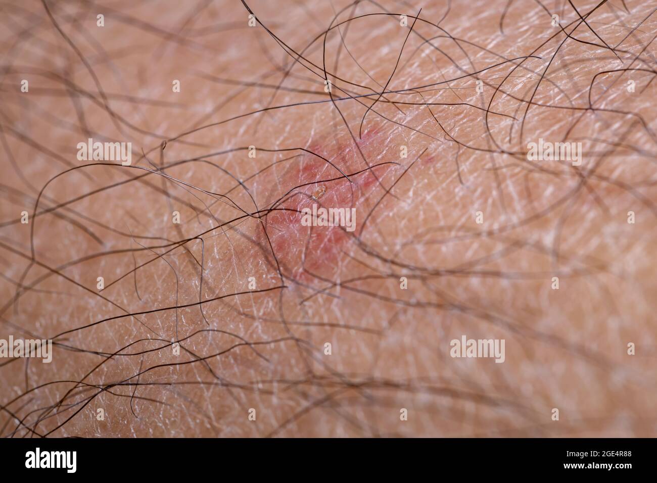 red irritation in Caucasian skin caused by an insect bite Stock Photo ...