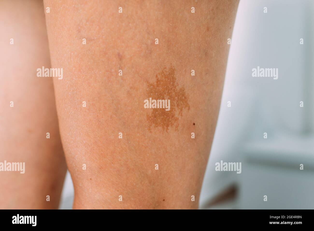 Large birthmark on the leg of a caucasian person Stock Photo - Alamy