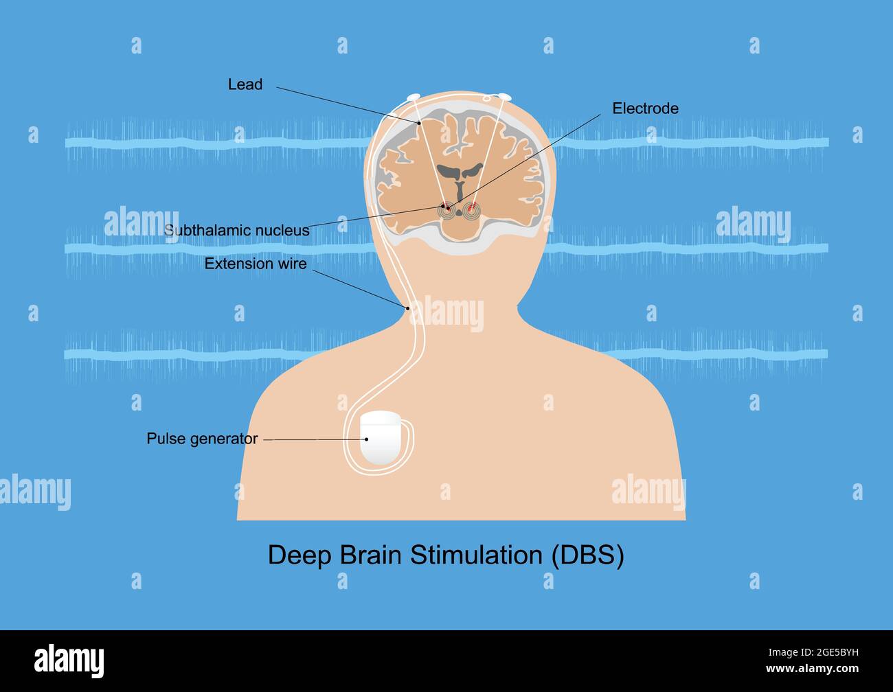 Parkinsons brain stimulation Stock Vector Images - Alamy