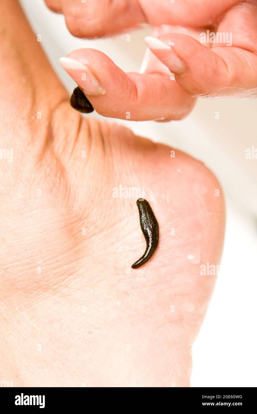 Leech therapy hi-res stock photography and images - Alamy